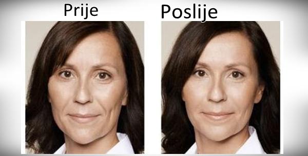 Botox - zatezanje kože čela i područja oko očiju s 40 ili 80 jedinica ...